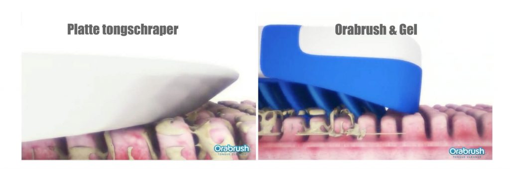 Amandelstenen: Zó zit het dus | Oorzaken + 5 Tips - VraagDeTandarts.nl