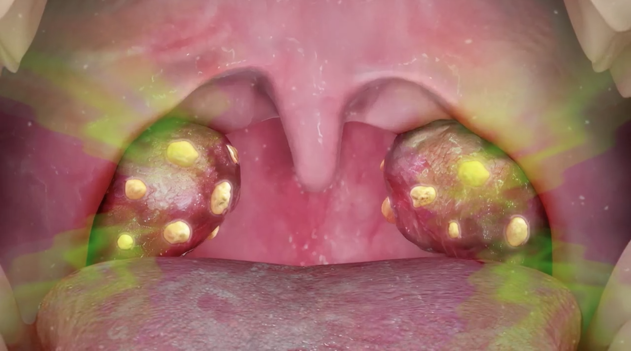 10 oorzaken van slechte adem (halitose) - VraagDeTandarts.nl